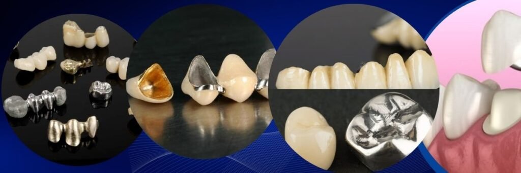 Metal Ceramic Crowns – Trishool Dental Hospital